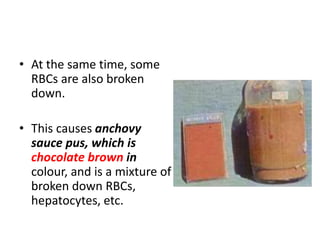 Anchovy Sauce Liver Abscess