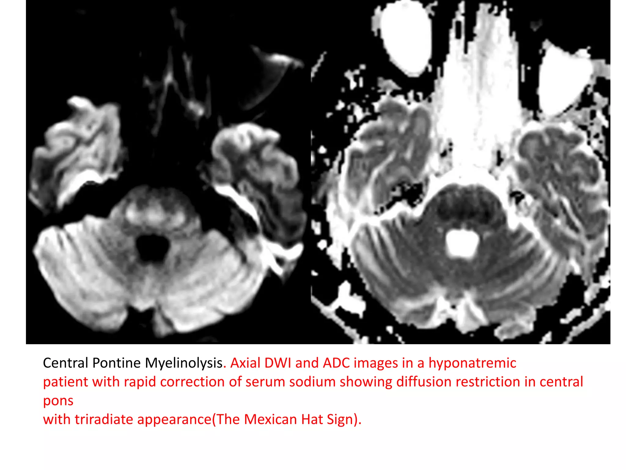 Amol toxic and metabolic encephalopathy syndrome | PPTX
