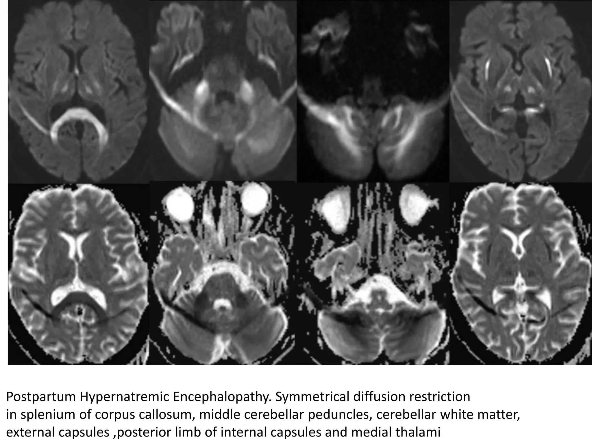 Amol toxic and metabolic encephalopathy syndrome | PPTX
