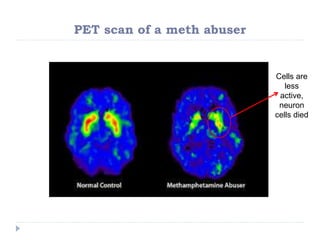 Amphetamine and ecstasy | PPTX