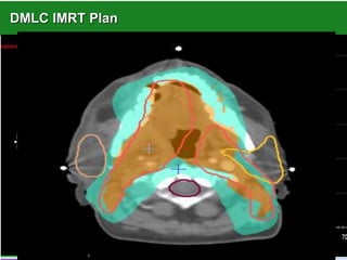 Past, present and future of radiotherapy technique in different sites ...
