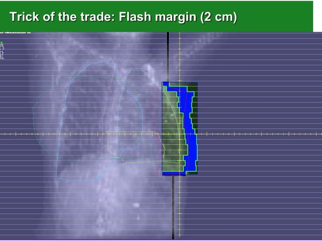 Past, present and future of radiotherapy technique in different sites ...