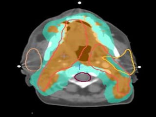 Past, present and future of radiotherapy technique in different sites ...