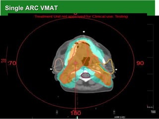Past, present and future of radiotherapy technique in different sites ...