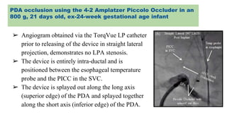 Amplatzer Piccolo Occluder clinical trial_19072022.pptx