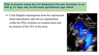 Amplatzer Piccolo Occluder clinical trial_19072022.pptx