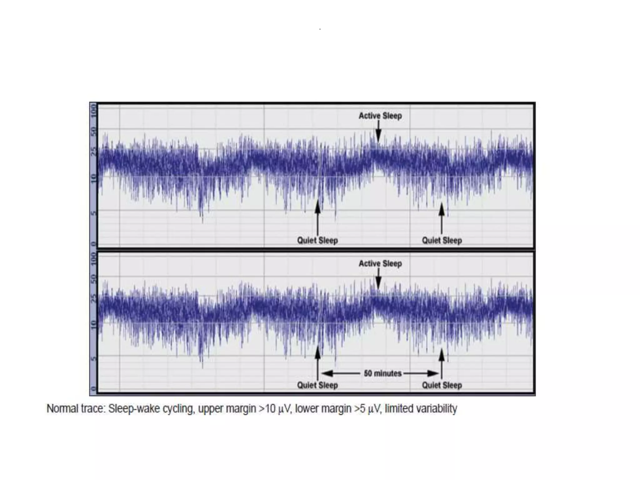Amplitude integrated eeg in neonates | PPTX