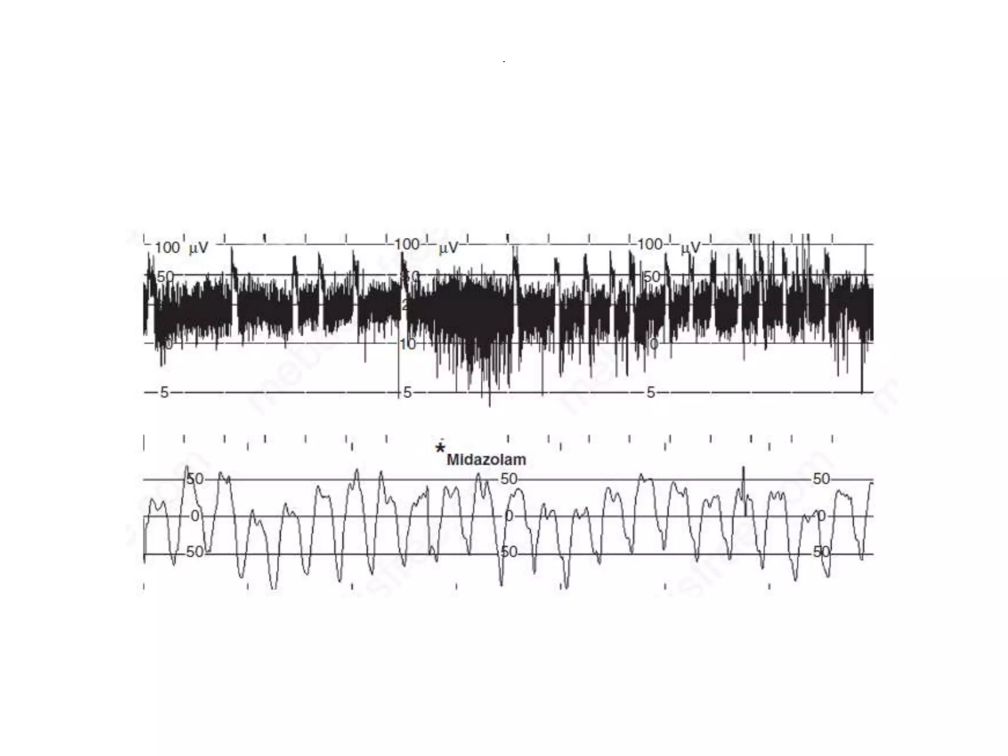 Amplitude integrated eeg in neonates | PPTX