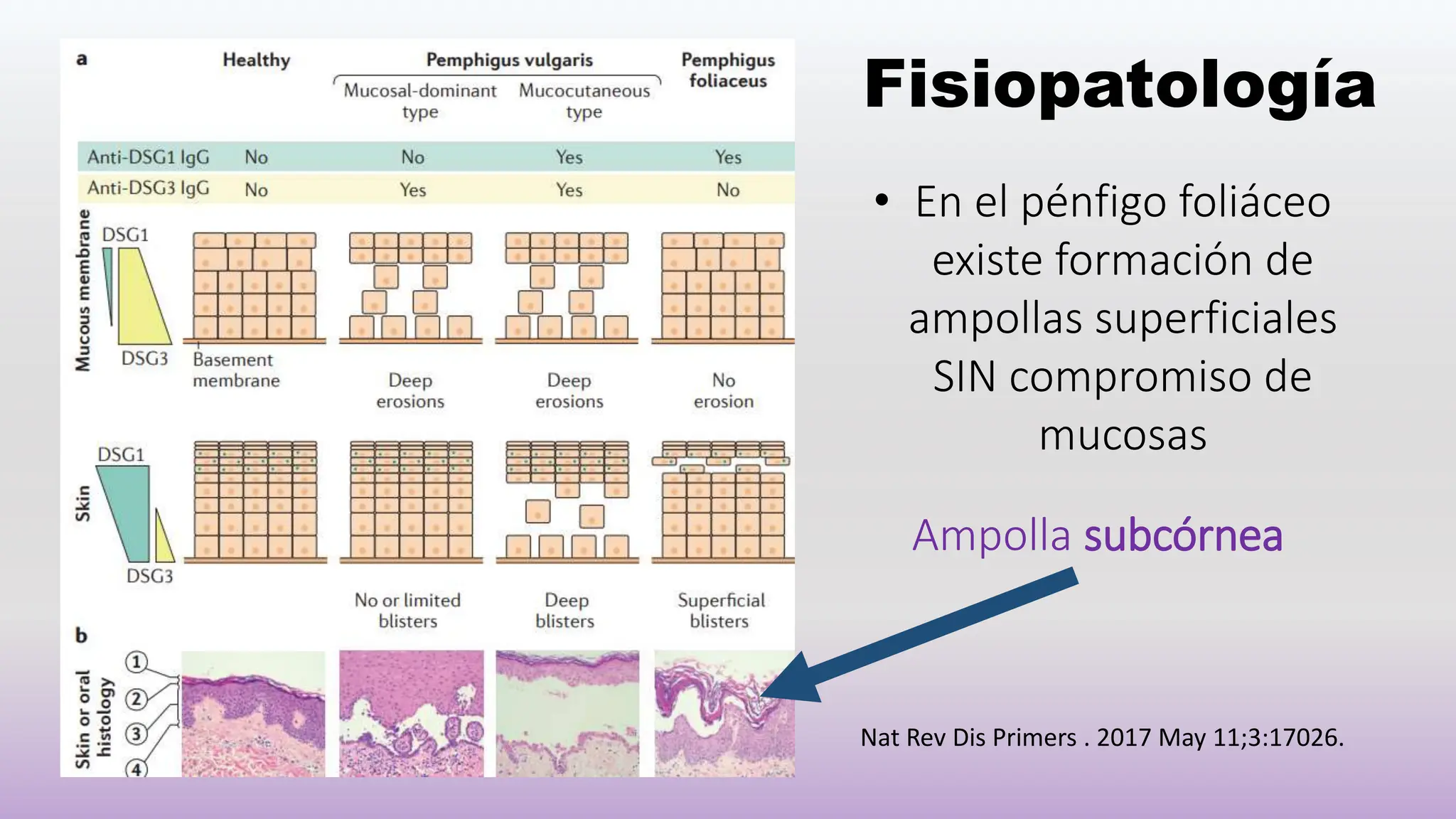 Dermatopatología: Ampollas Intraepidérmicas (Pénfigo Vulgar, Foliáceo y ...