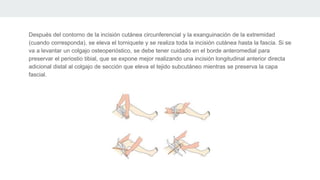 Amputación transtibial y de tobillo.pptx