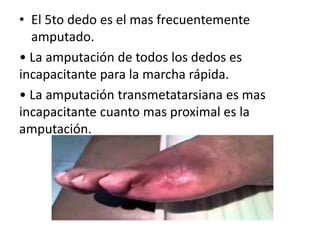 AMPUTACION 1ER Y 5TO DEDOS Y ORTEJOS.pptx