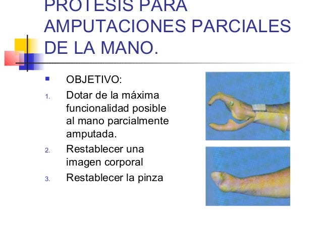 Amputaciones De La Mano Y De La Muñeca
