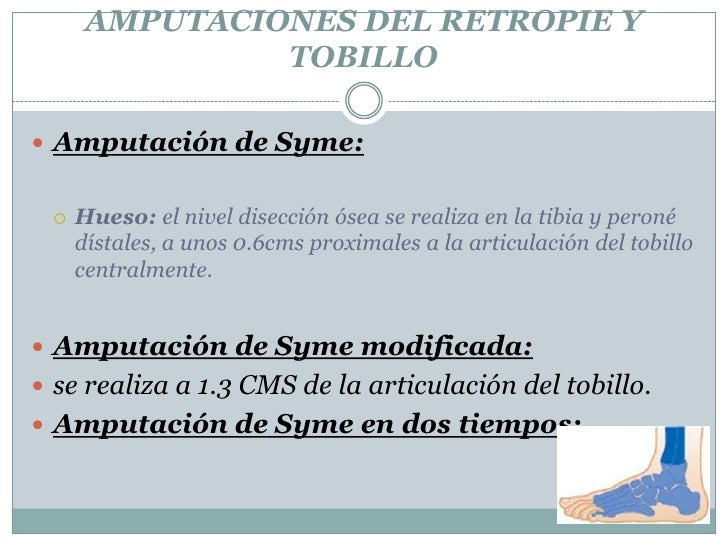 Amputaciones del pie