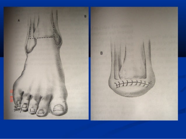 Amputaciones de pie y tobillo