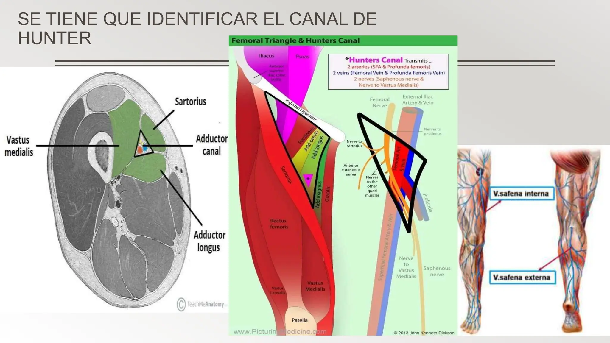 Tecnia quirurgica de amputacion supracondileapptx | PPTX