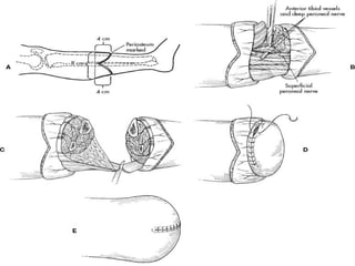 Amputation extremity | PPT