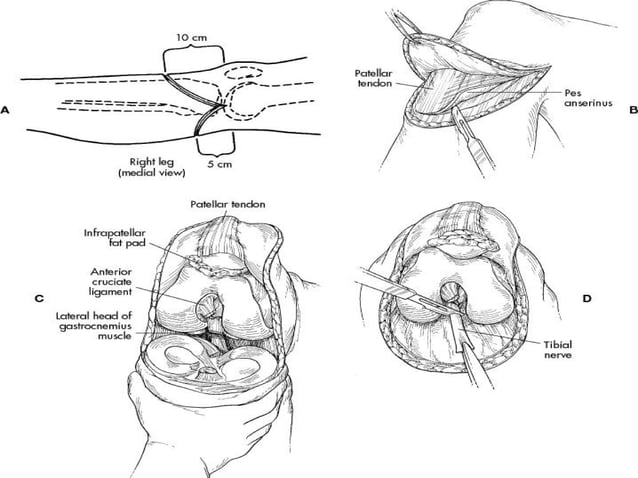 Amputation extremity | PPT