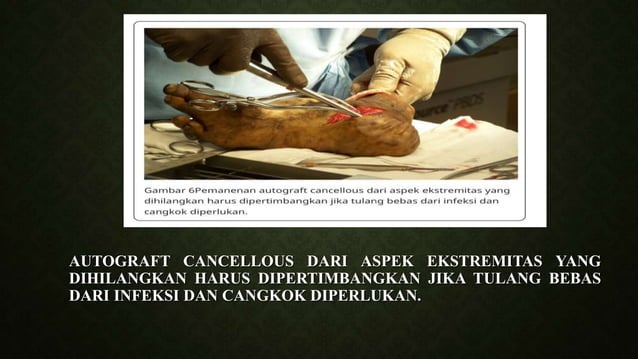 AMPUTASI TRANSTIBIAL fix.pptx