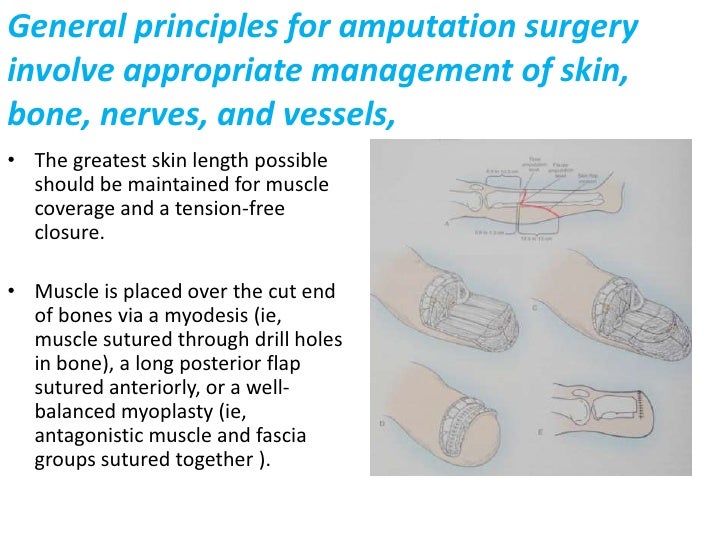 myodesis of muscles | WordReference Forums