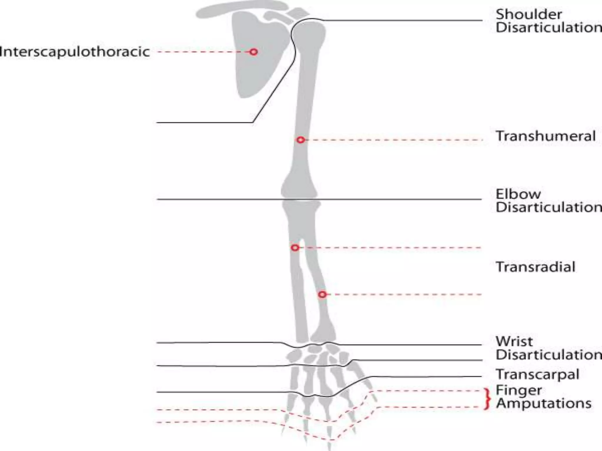 Amputation | PPTX
