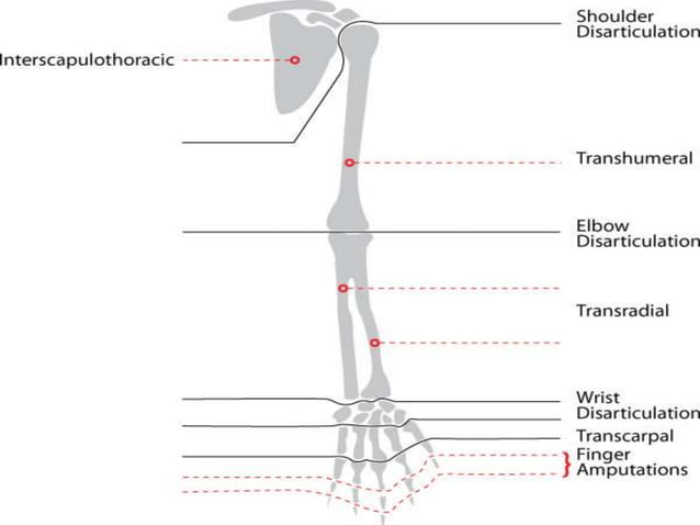 Amputation | PPTX | Death, Injury, or Military Conflict | Sensitive Topics