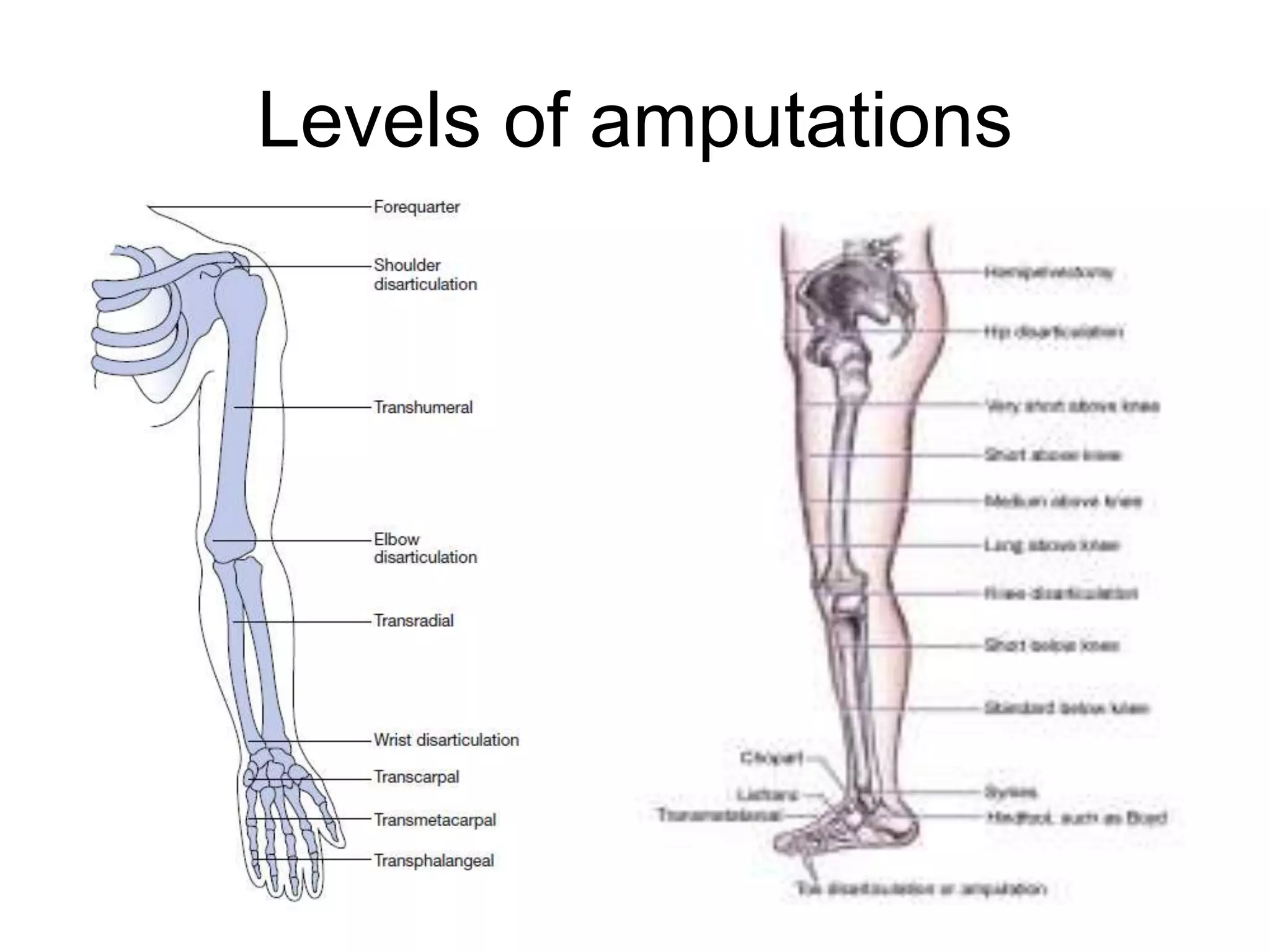 Amputation | PPTX