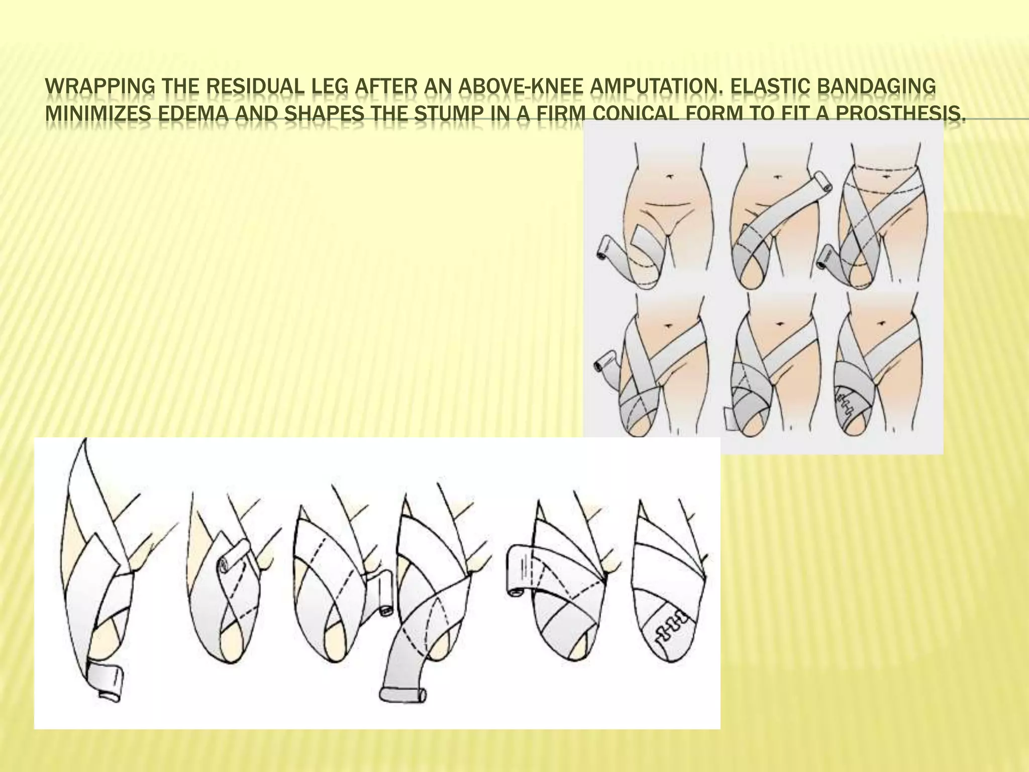 Amputation | PPTX