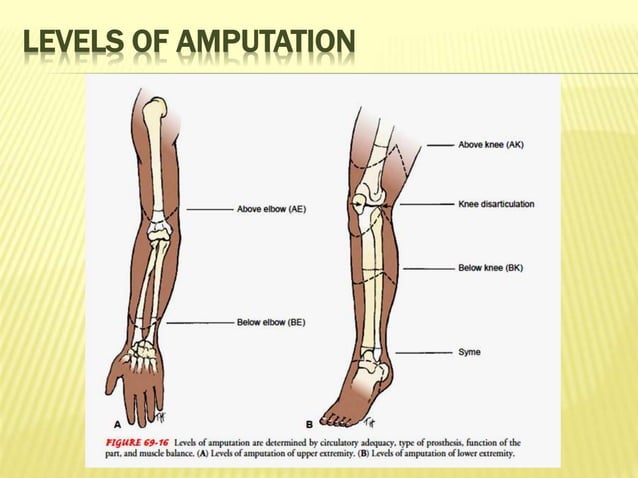 Amputation | PPTX | First Aid | Injuries