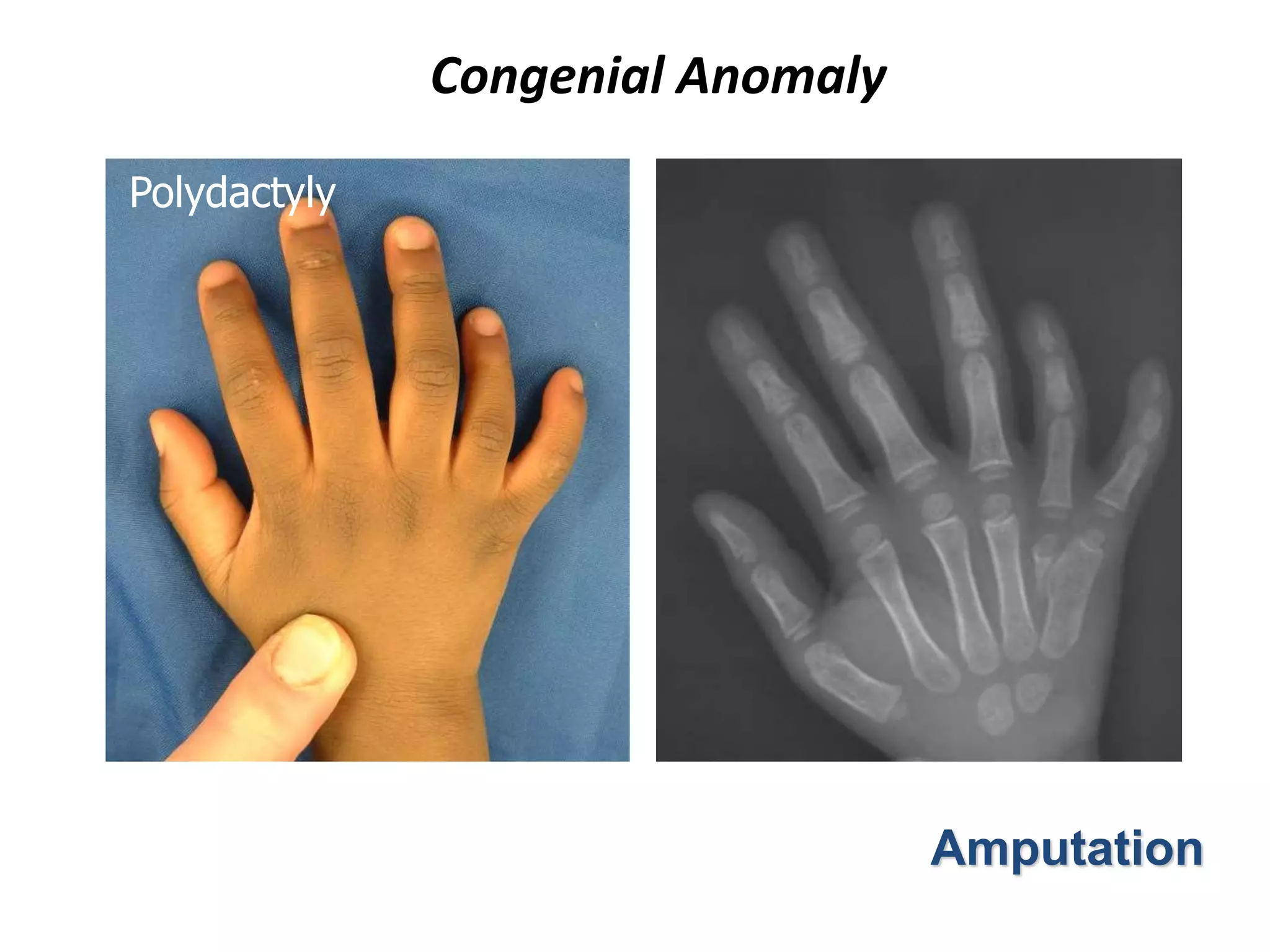 Amputation | PPTX