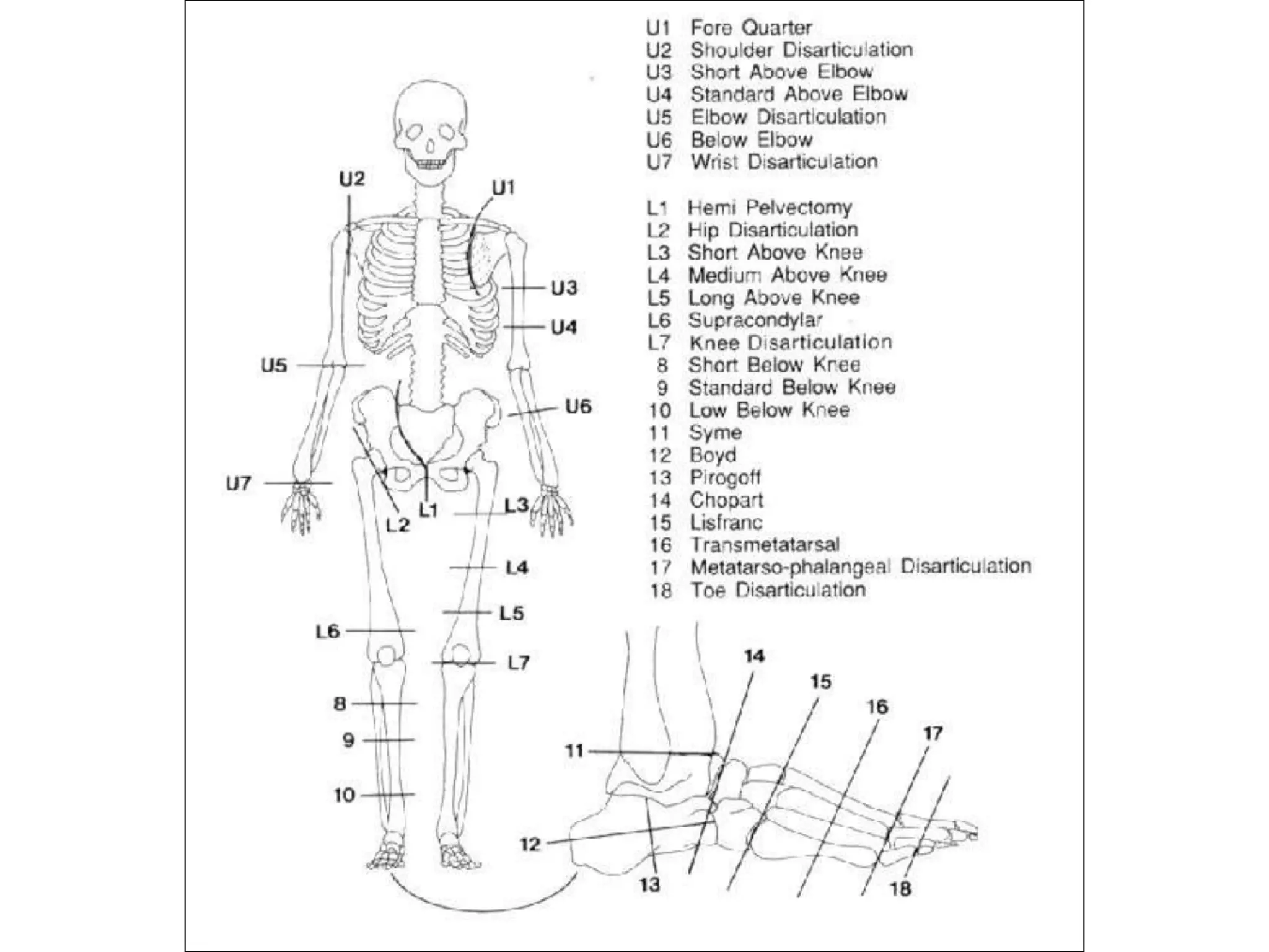 Amputation | PPTX
