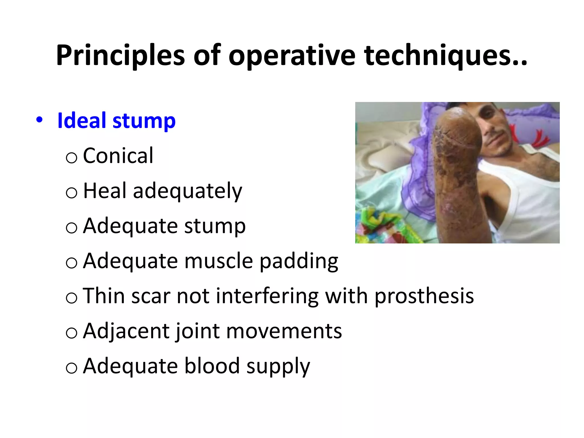Amputation | PPTX