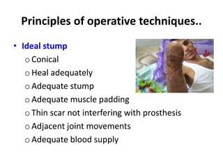 Amputation | PPTX