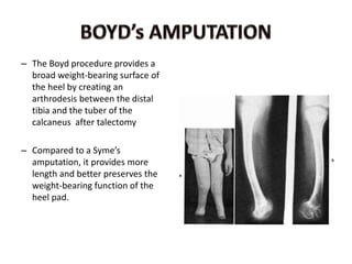 Amputation | PPT