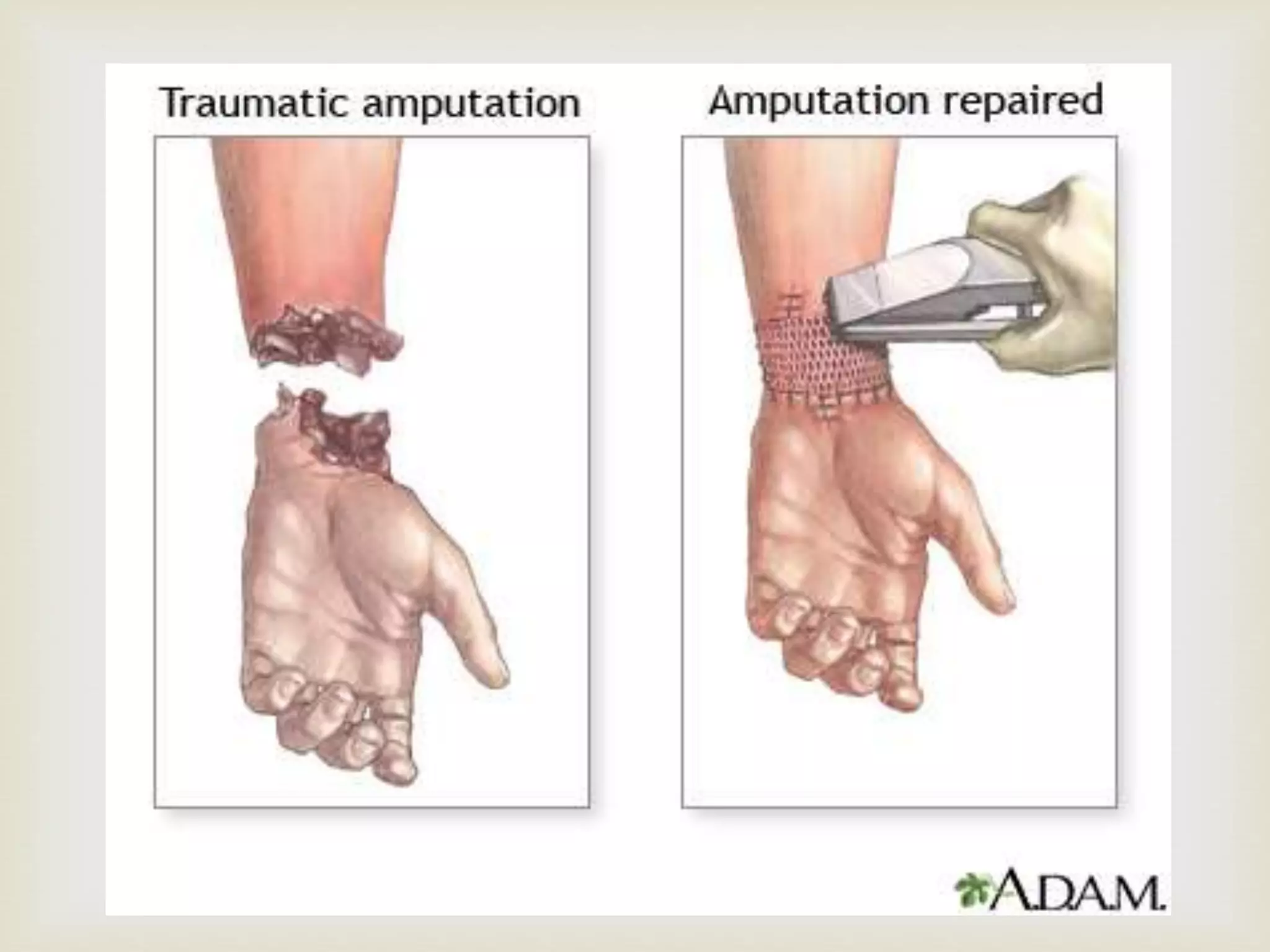 Amputation and role of an occupational therapist in amputee | PPTX