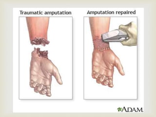 Amputation and role of an occupational therapist in amputee | PPTX