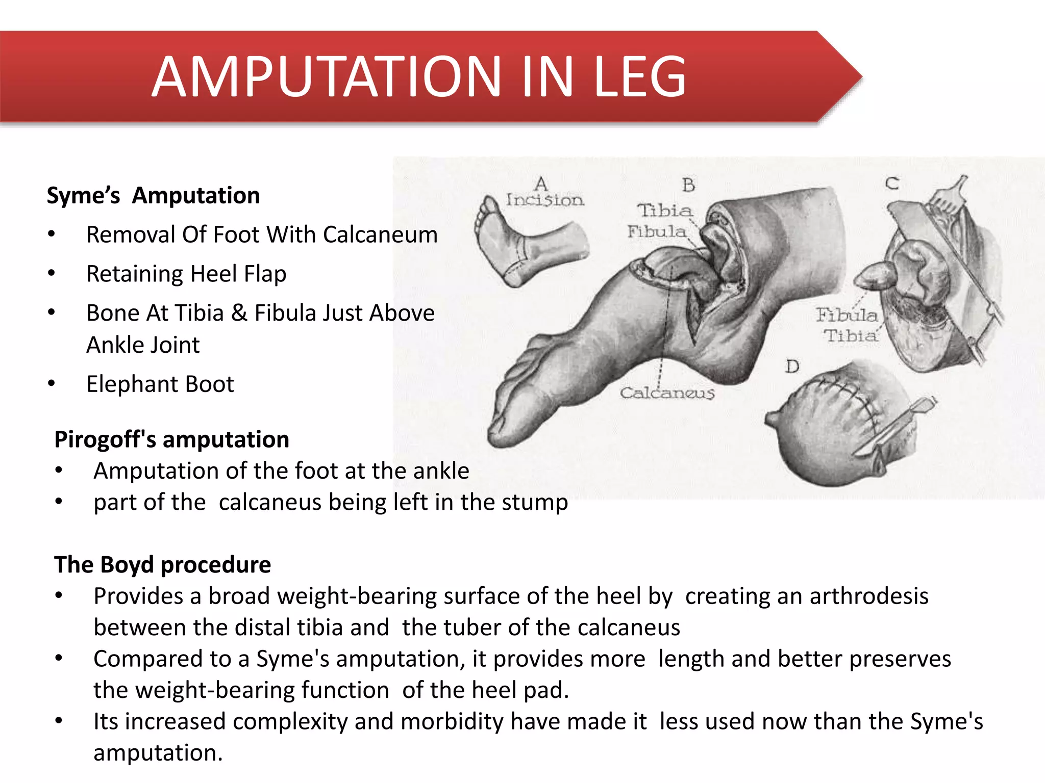 Amputation Orthopaedics | PPTX