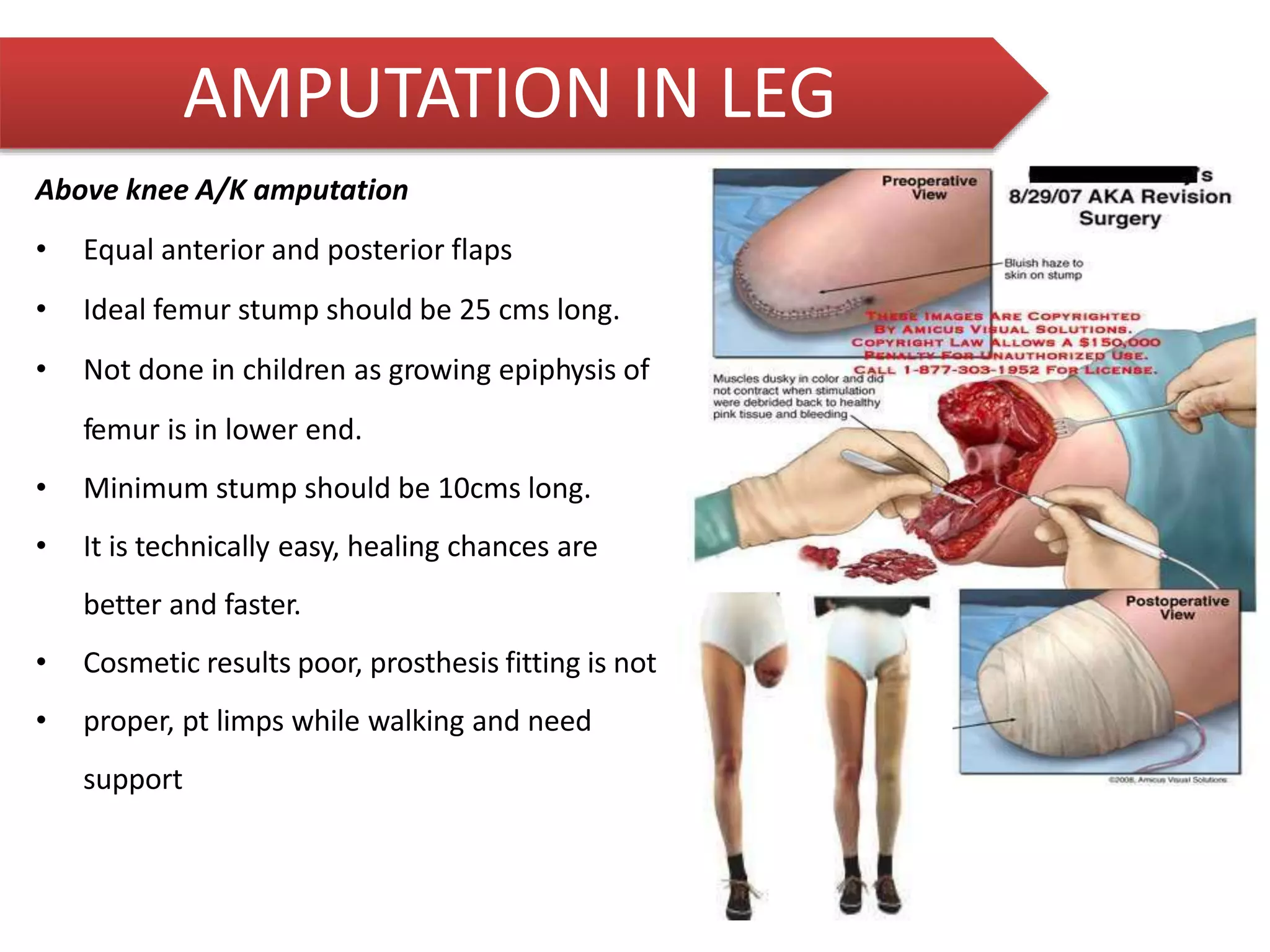Amputation Orthopaedics | PPTX