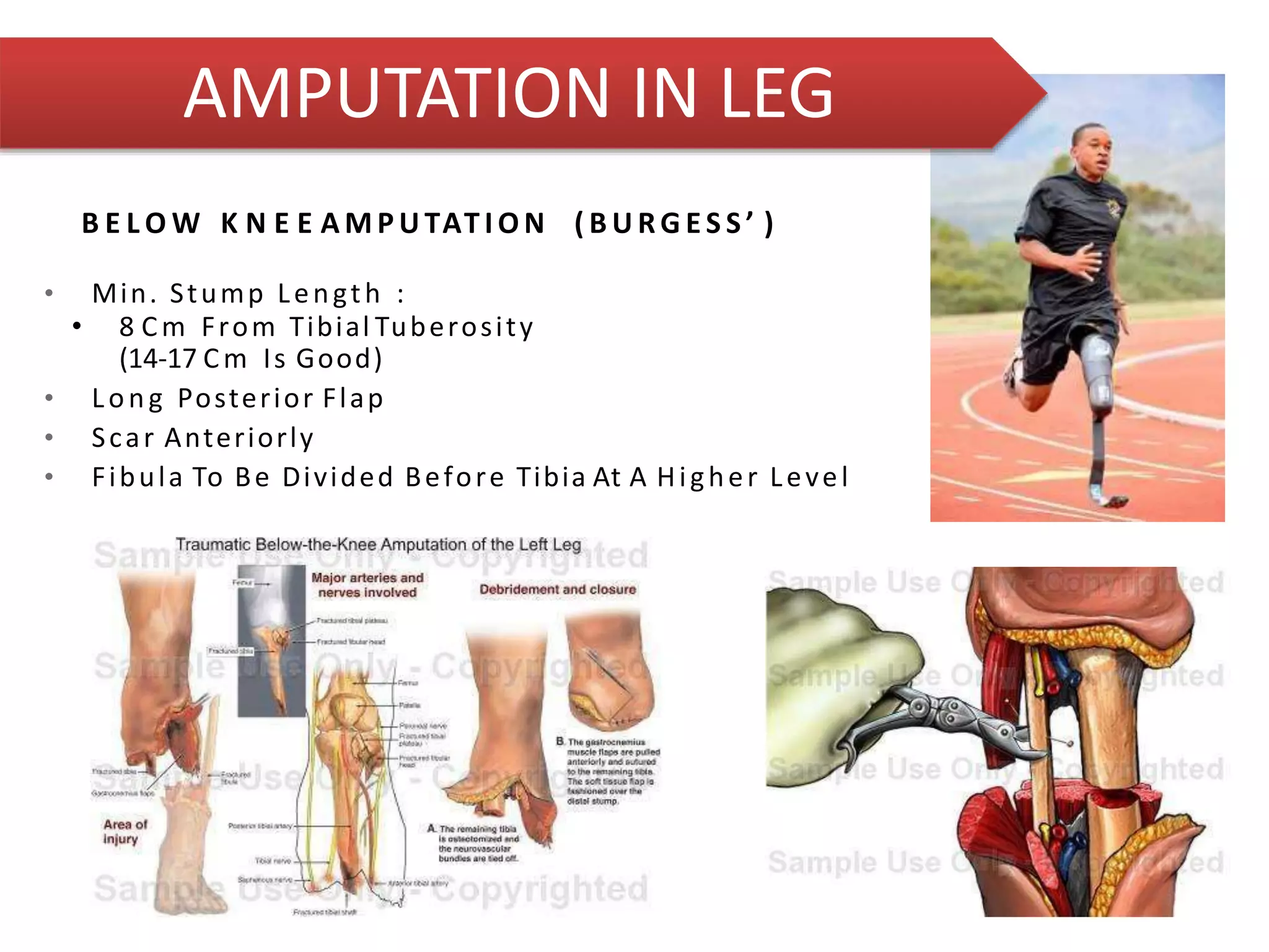 Amputation Orthopaedics | PPTX
