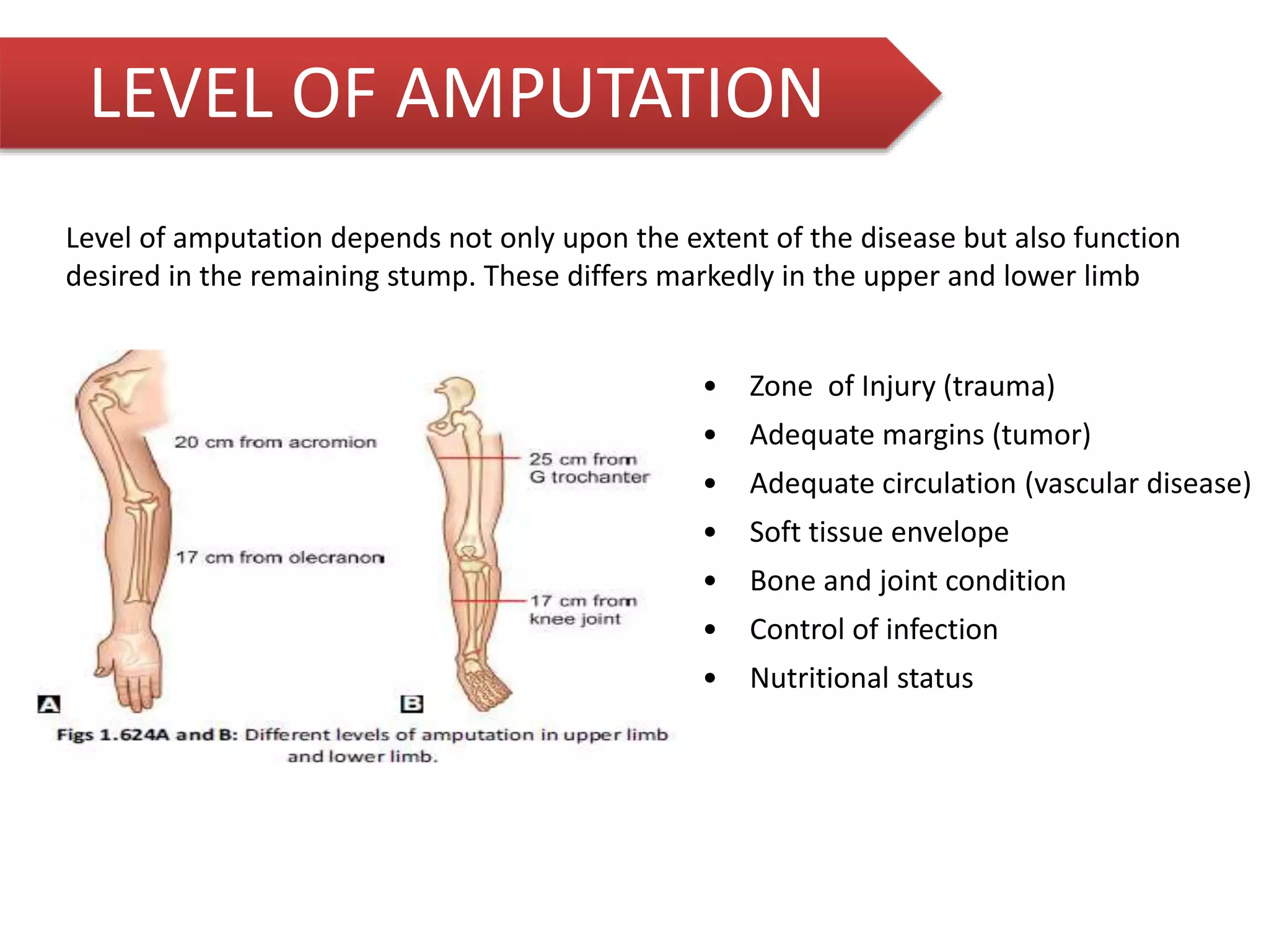 Amputation Orthopaedics | PPTX