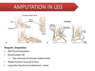 Amputation Orthopaedics | PPTX