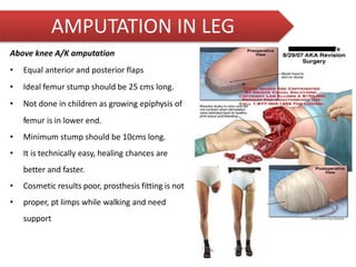 Amputation Orthopaedics | PPTX