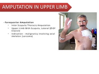 Amputation Orthopaedics | PPTX