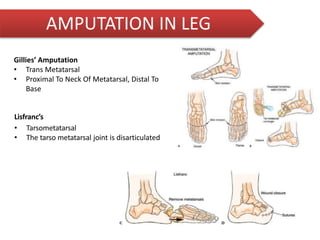 Tarsometatarsal Amputation