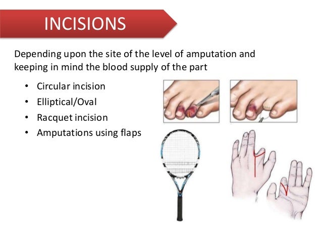 Amputation Orthopaedics