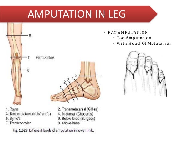 Amputation Orthopaedics