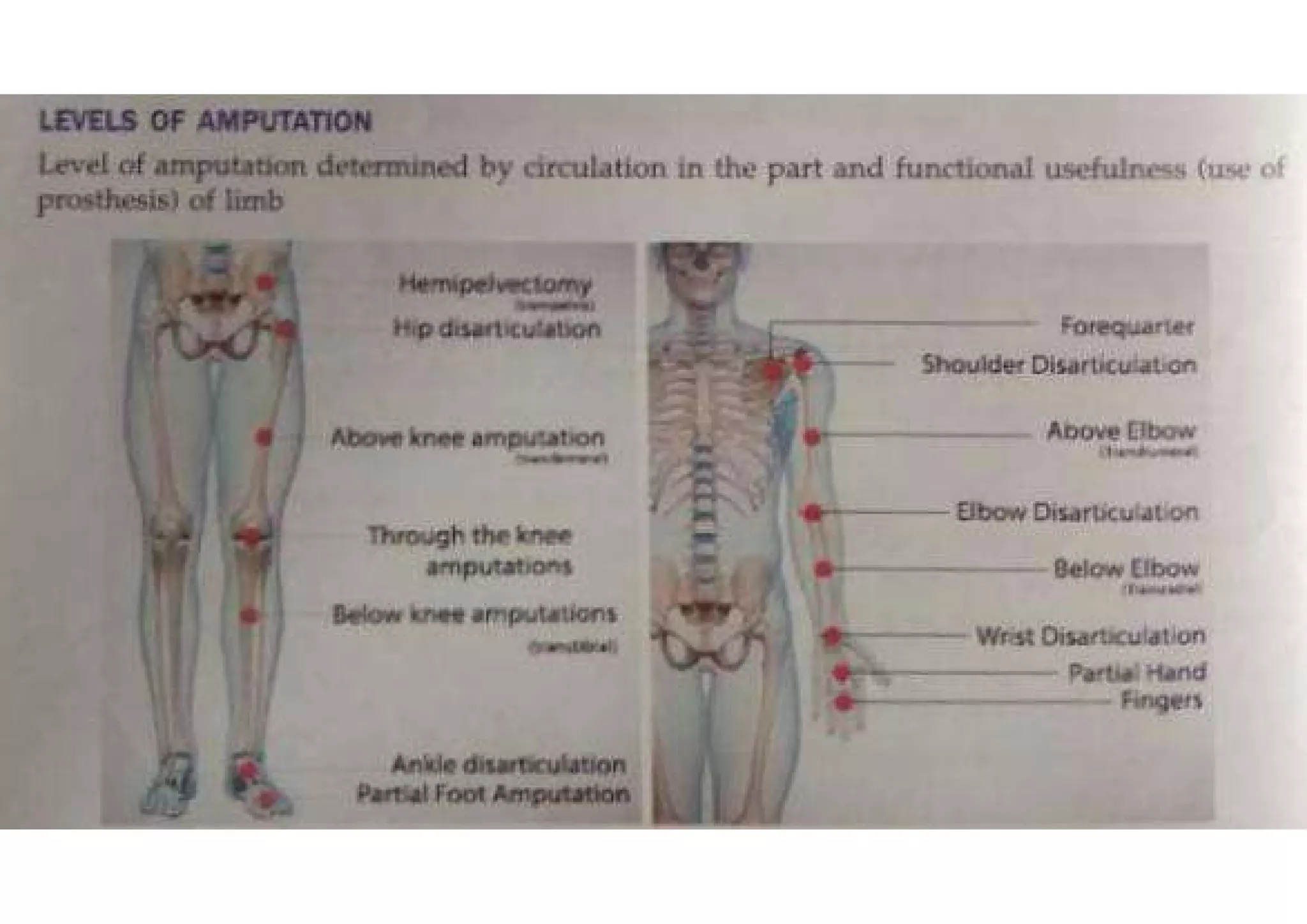 Amputation For G.N.M 2nd & B.Sc.2nd & 3rd Year Nursing Student. | PDF