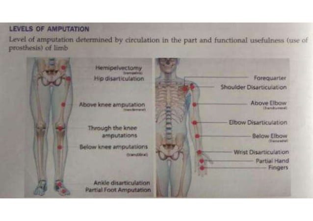 Amputation For G.N.M 2nd & B.Sc.2nd & 3rd Year Nursing Student. | PDF ...