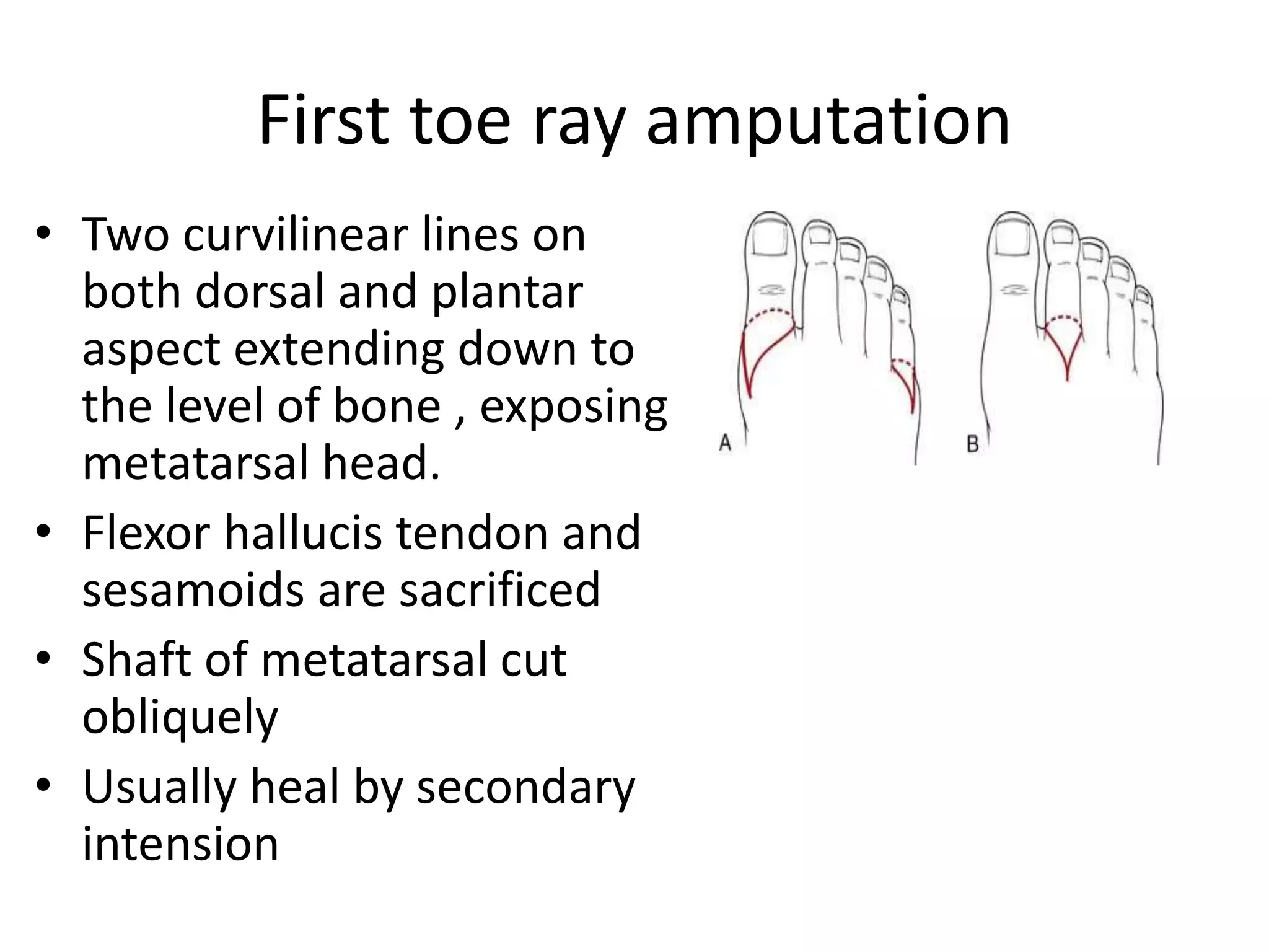 amputation.pptx