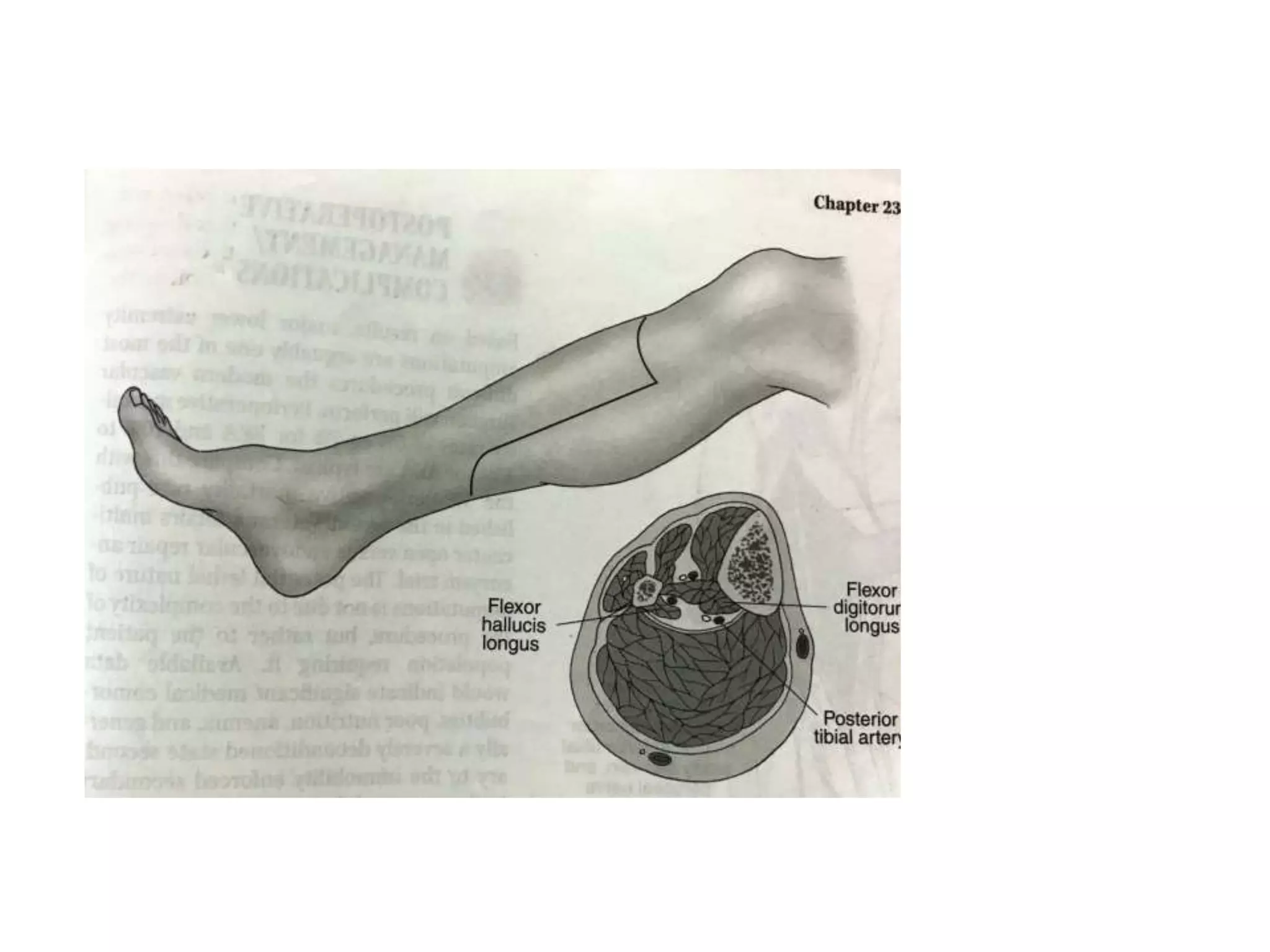 amputation.pptx