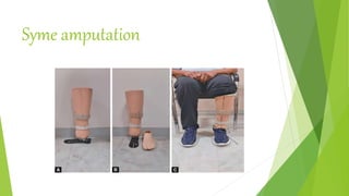 Amputation.pptx | Death, Injury, or Military Conflict | Sensitive Topics